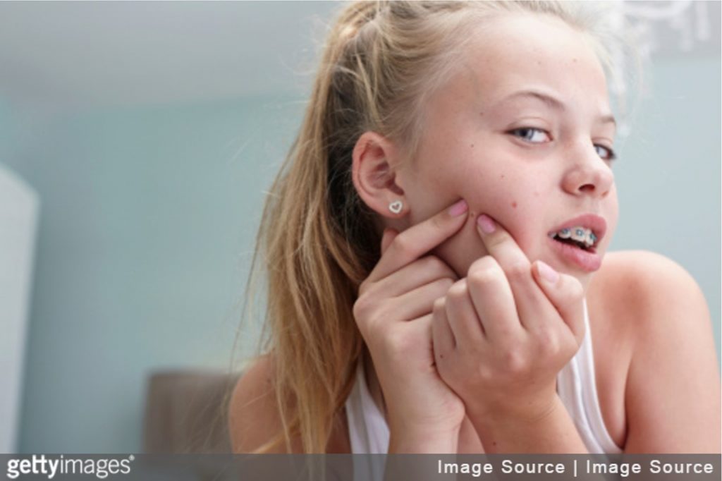 Acne Na Adolesc ncia Mamis Na Madrugada acne-na-adolesc-ncia-mamis-na-madrugada